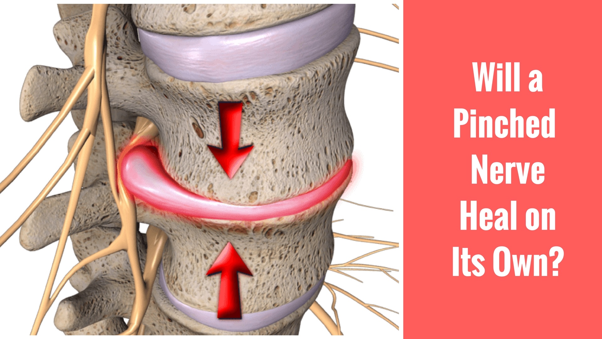 Will A Pinched Nerve Heal On Its Own SpineCare St Joseph MI