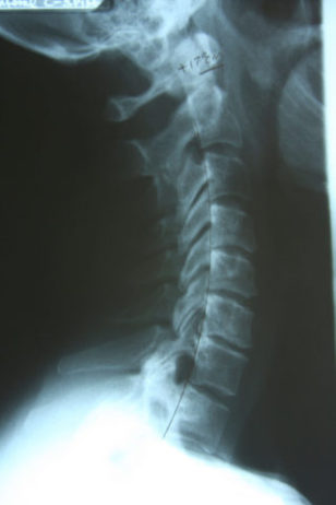 Spinal Decompression Therapy | SpineCare Decompression and Chiropractic ...