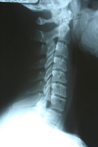 Spinal Decompression Therapy | SpineCare Decompression and Chiropractic ...