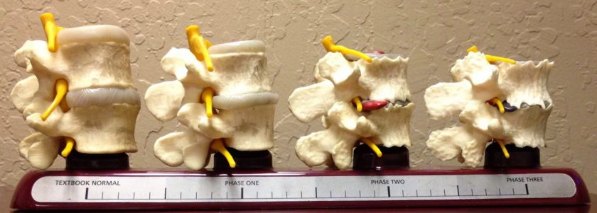Degenerative Disc Disease: Progression, Symptoms, and Chiropractic