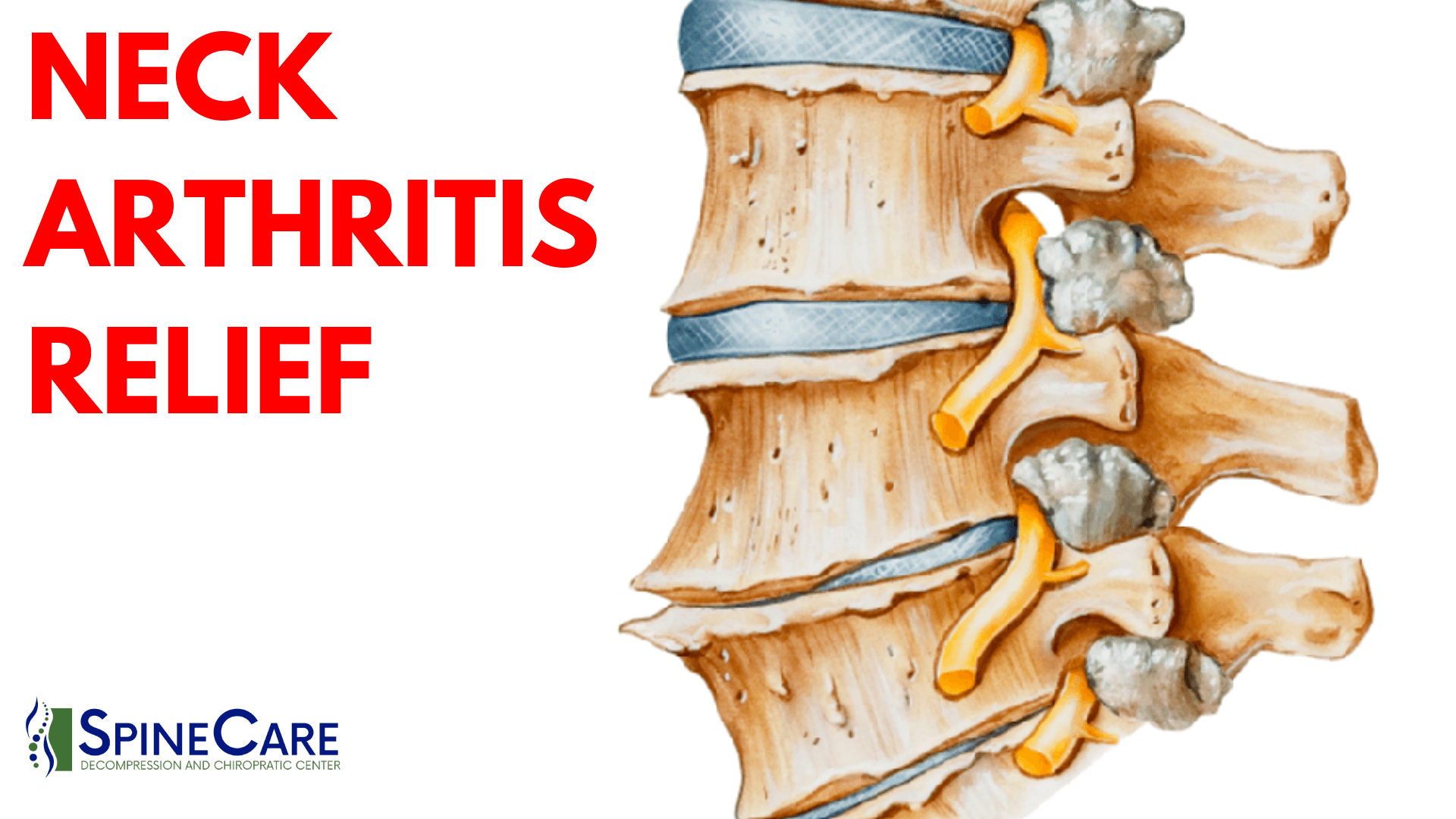 CERVICAL SPONDYLOSIS Causes Symptoms And Treatment